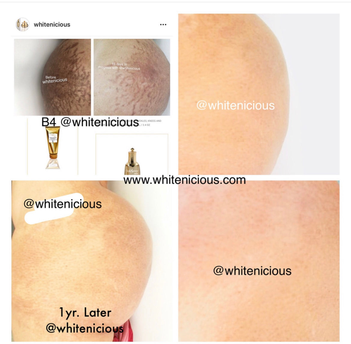 STRETCHMARK Eraser Cream – Whitenicious