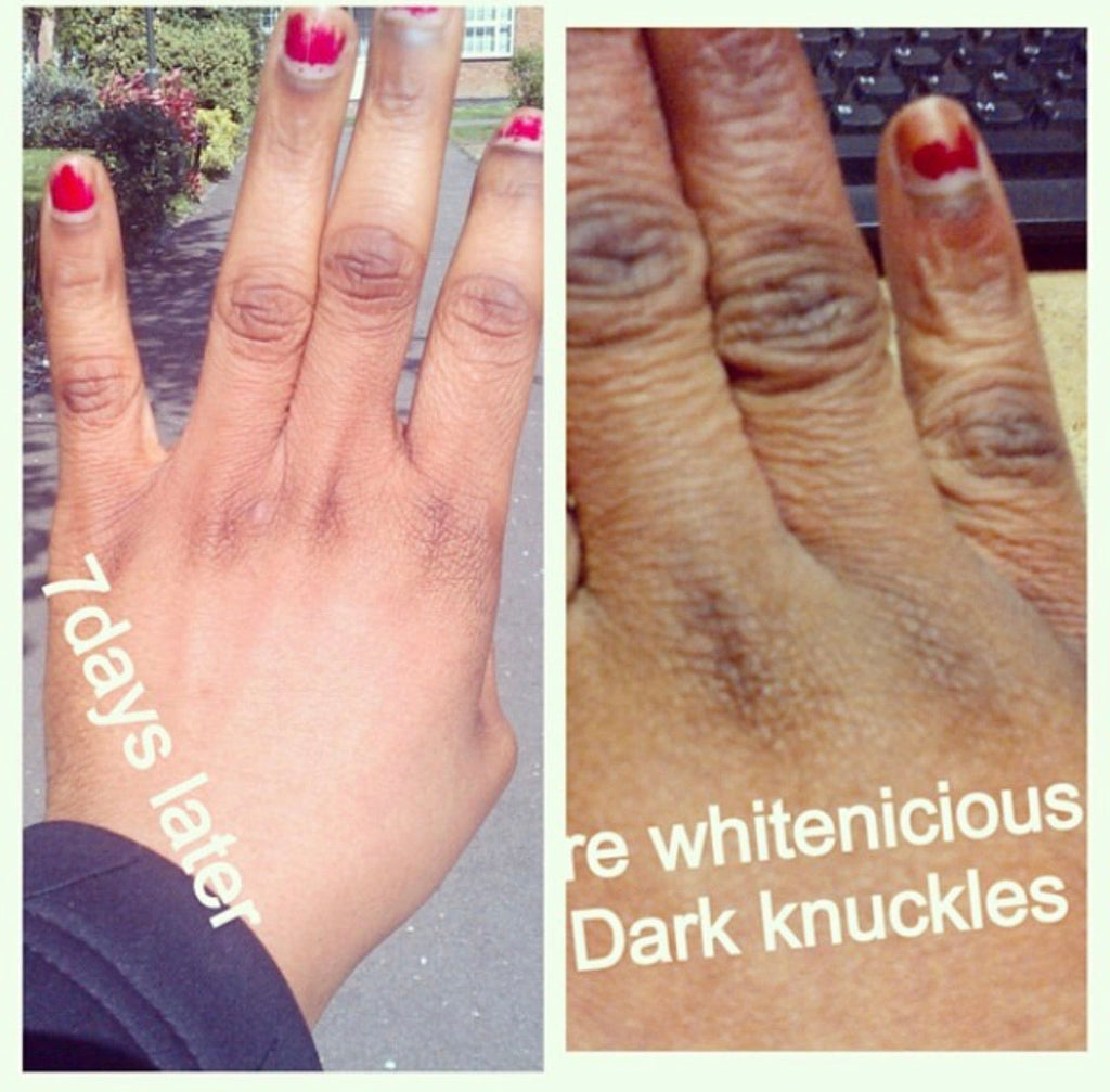 Dark Knees,knuckles & Elbows Lightening Cream 100ML – Whitenicious